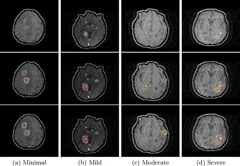 Assessing Lesion Segmentation Bias Of Neural Networks On Motion Corrupted Brain Mri