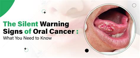Early Oral Cancer On Gums