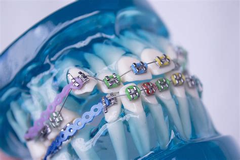 Braces Colors For Summer
