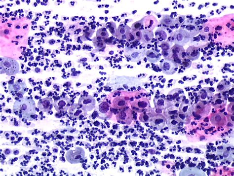 Parabasal Cells Vs Koilocytes