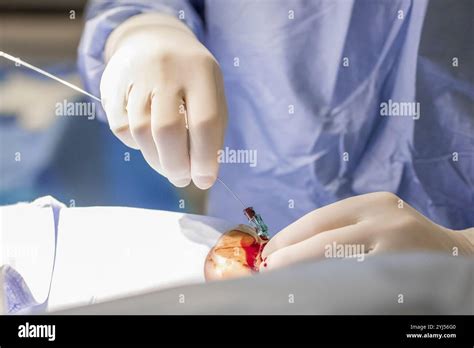 A Surgical Procedure Conducted With Precision Tools And In A Sterile