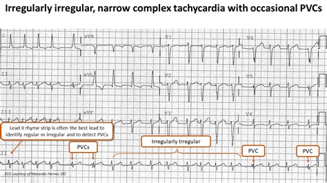 Atrial Fibrillation ECG TeachIM