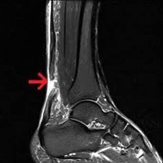 Achilles Tendon Rupture — Tonya An Md