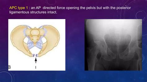 Pelvic Injuries And Associated Injuries Pptx