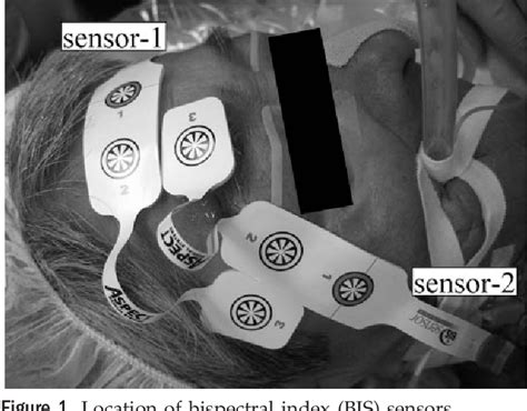 Figure 1 From The Validity Of Bispectral Index Values From A Dislocated Sensor A Comparison