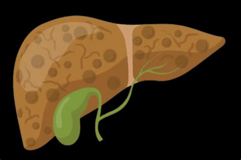 Liver Fibrosis Curable What You Need To Know Qpior