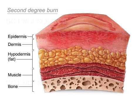 Second Degree Burn Stock Image Science Source Images