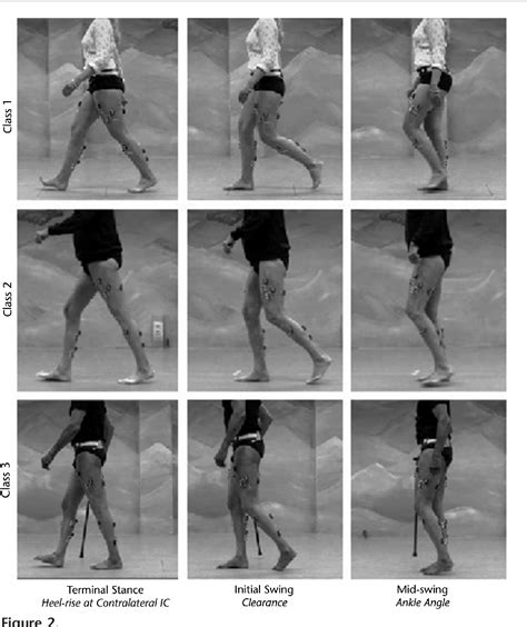 Figure 2 From Newly Identified Gait Patterns In Patients With Multiple Sclerosis May Be Related
