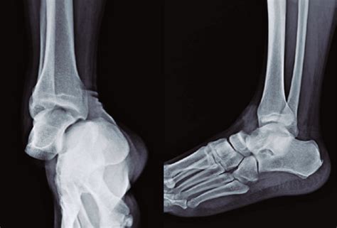 Initial Radiograph Of The Right Ankle Showing Talus Dislocation Without