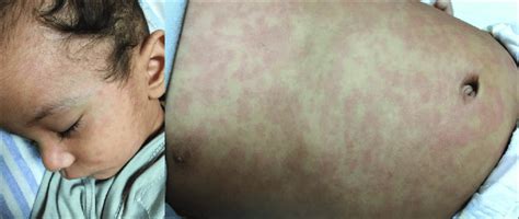 Photographs Of A Measles Patient With Maculopapular Rash Download Scientific Diagram