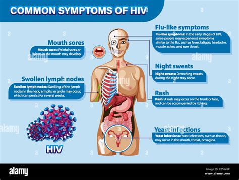 Informative Poster Of Common Symptoms Of Hiv Illustration Stock Vector Image And Art Alamy