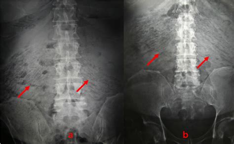 Necrotizing Fasciitis X Ray