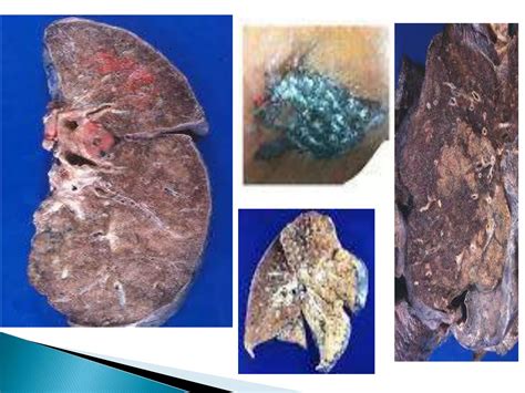 Pathological Calcification Pptx