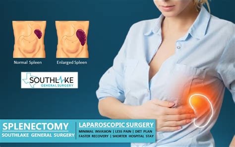 Laparoscopic Splenectomy Southlake General Surgery