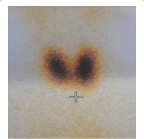 Thyroid Scan Showing Diffuse Homogenous Uptake Of Radioactive Tracer In