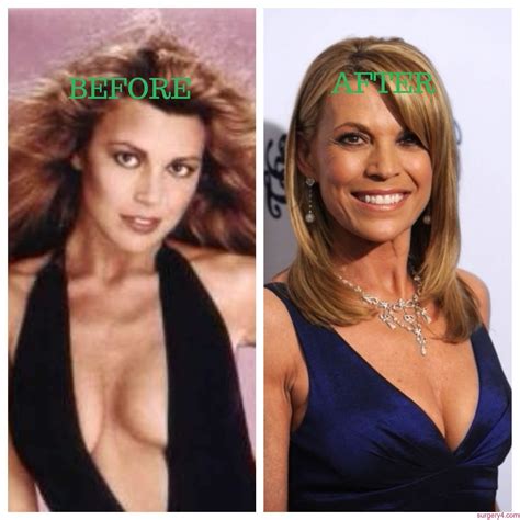 Brandi Passante Plastic Surgery Photos Before And After Surgery4