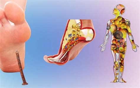 Vết Thương Nhỏ Cũng Có Thể Gây Uốn Ván