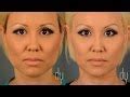 BOTOX BEFORE AND AFTER Desmotsdart Image Blog
