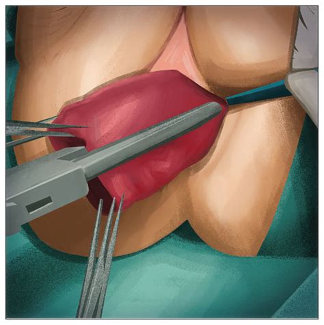 Perineal Proctectomy