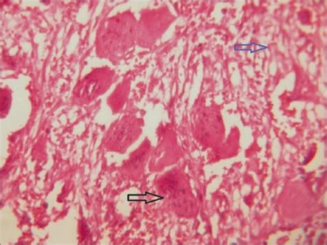 Microscopy Revealed Highly Cellular Stroma Consisting Of Plenty Of Download Scientific Diagram