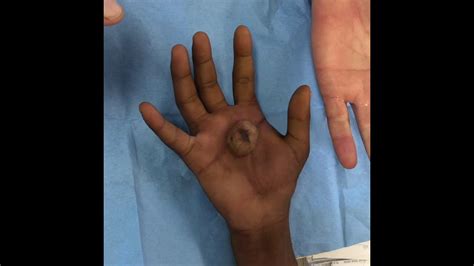 Horseshoe Abscess Hand