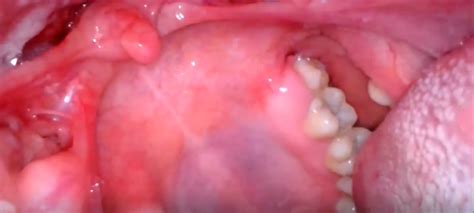 K1m Reverse Endoscope View