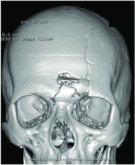 Compression Fracture Skull