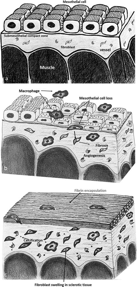 Imaging Pearls And Differential Diagnosis Of Encapsulating Peritoneal Sclerosis Emphasis On