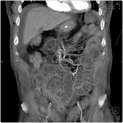 Small Bowel Enteritis Small Bowel Radiology Case Studies Ctisus Ct