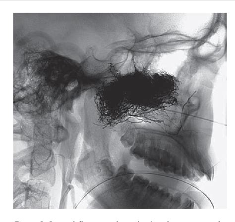 Figure 5 From Direct Endoscopic Intratumoral Injection Of Onyx For The Preoperative Embolization