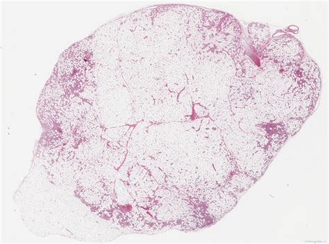 Angiolipoma Ottawa Atlas Of Pathology