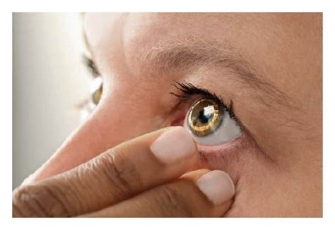 A Sensimed Triggerfish Contact Lens Sensor B The Contact Lens