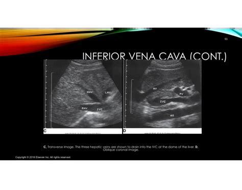 Ivc Ultrasound Quiz