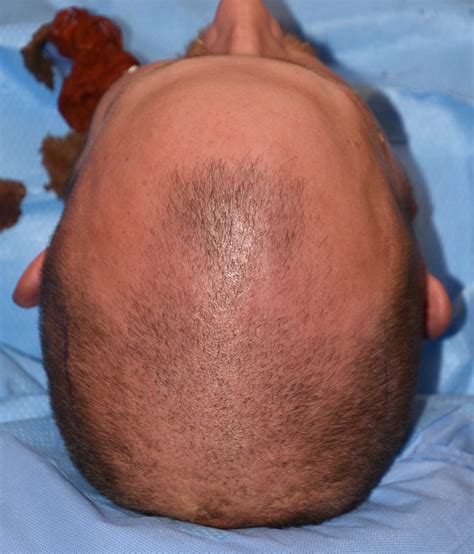 Ear Protrusions After Temporal Reduction Top View Dr Barry Eppley