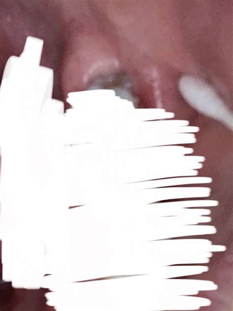 [잡담] 사랑니 빼야할까 사진주의 인스티즈 Instiz 일상 카테고리