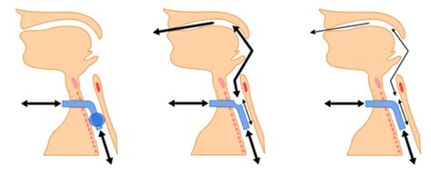 Cuffed Tracheostomy Tube Vs Uncuffed Bluselect® Uncuffed Tracheostomy