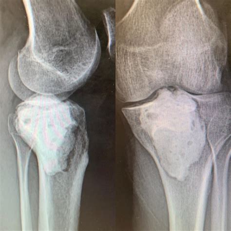 Had A Tumor Removed From My Tibia Last Week This X Ray Shows The Bone