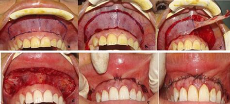 Cephalometric Analysis To Determine Skeletal Classification Download