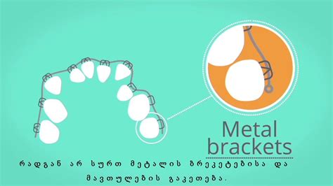 კბილების გასწორება ბრეკეტების გარეშე გამჭირვალე კაპები ელაინერები Youtube