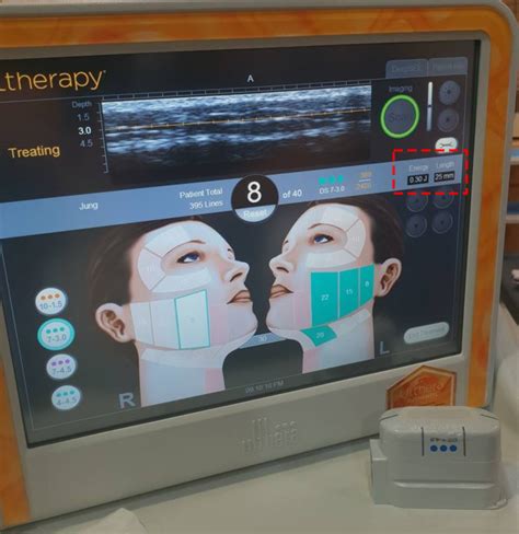 울쎄라 리프팅 에너지 강도를 높이면 효과가 더 좋을까 강도별 통증 차이 비교 네이버 블로그