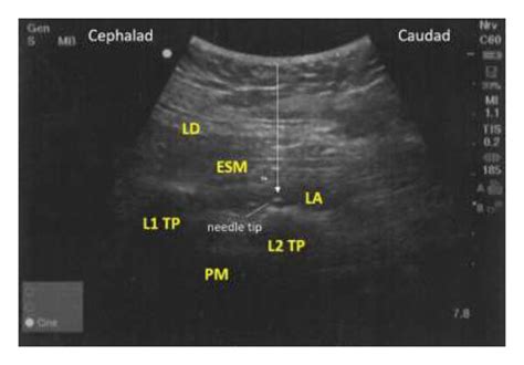 Ultrasound Image Of Lumbar Erector Spinae Plane Block Ld Latissimus