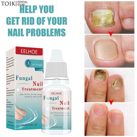 Effective Nail Fungus Treatment Nail Repair Ingrown Toenail Remover