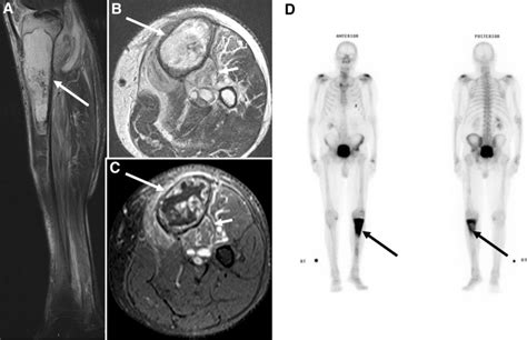 70 Year Old Man With Grade 3 Chondrosarcoma In The Left Proximal Tibia Download Scientific