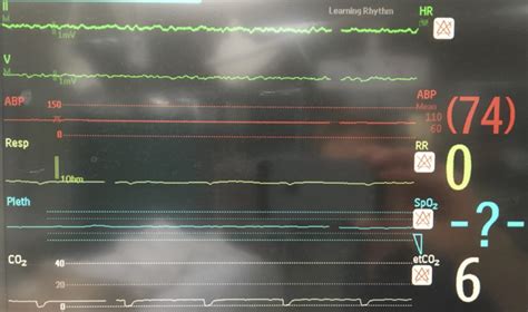 Vf On Va Ecmo Monitor Intensive