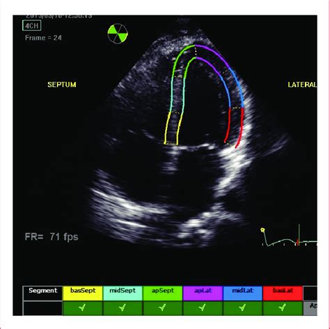 Echocardiograph Shows Segmental Analysis Of Left Ventricle After 2d