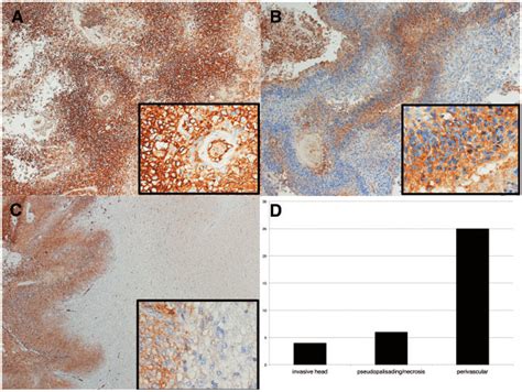 Localization Of GLUT Expression In Glioblastoma Tumor Cells A Download Scientific Diagram