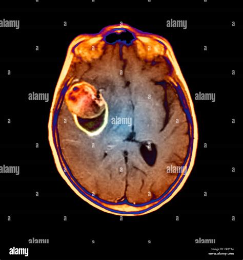 Coloured Computed Tomography Ct Scan Of The Brain Of A 58 Year Old Patient That Has Had An