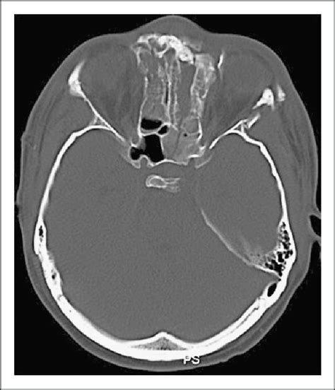 Anterior Maxillary Sinus Wall Fracture