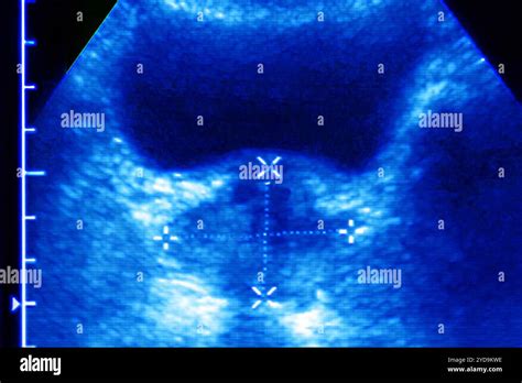Prostate And Bladder Control Examination With Measurements Of The
