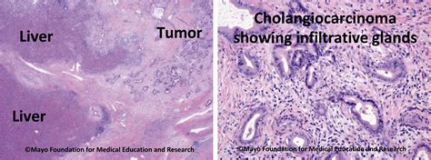 Perihilar Cholangiocarcinoma Mayo Clinic Proceedings